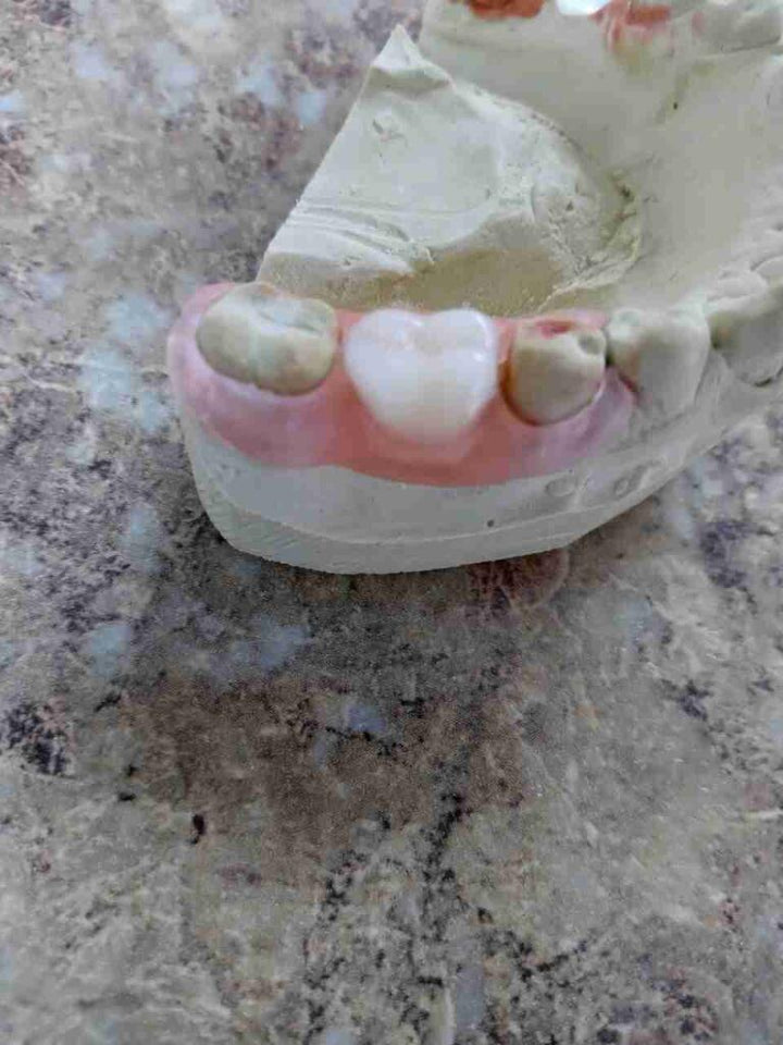 Flexible Custom Nesbit Denture – Saldentures