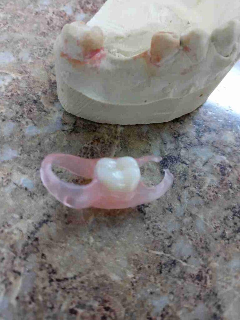 Flexible Custom Nesbit Denture – Saldentures