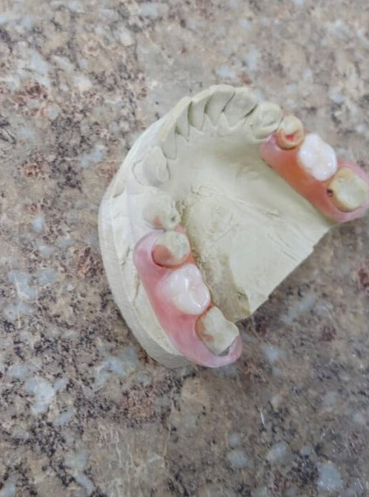 Flexible Custom Nesbit Denture – Saldentures